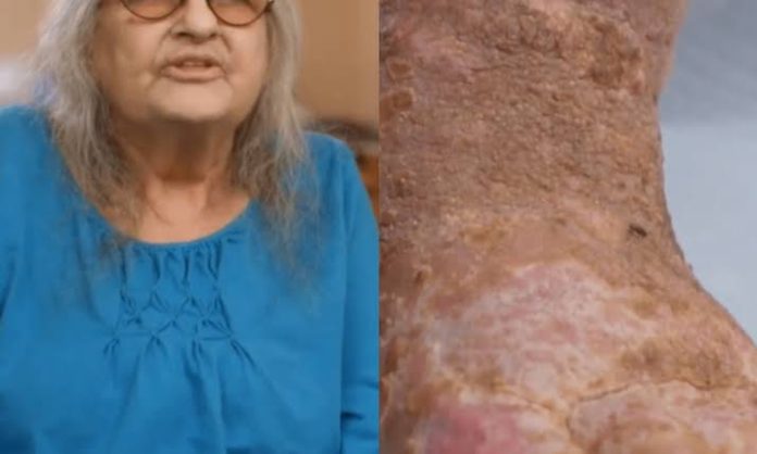 Woman with ‘maggots in between her toes’ devastated after being sent ...