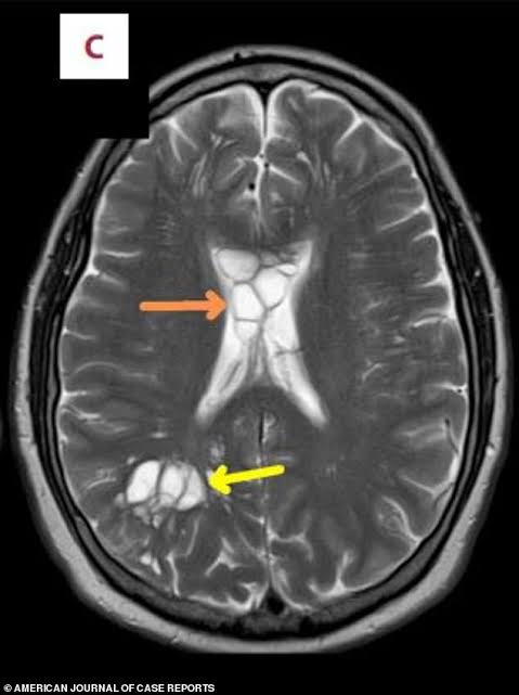 Man, 52, who suffered constant migraines is found to have a live WORM ...