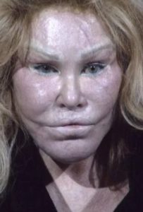 Before And After Plastic Surgery Face Transformation Of Socialite ...